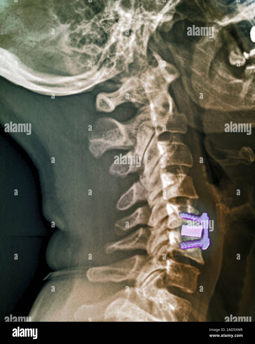 Cervical intervertebral disc implant. Coloured lateral X-ray of the ...