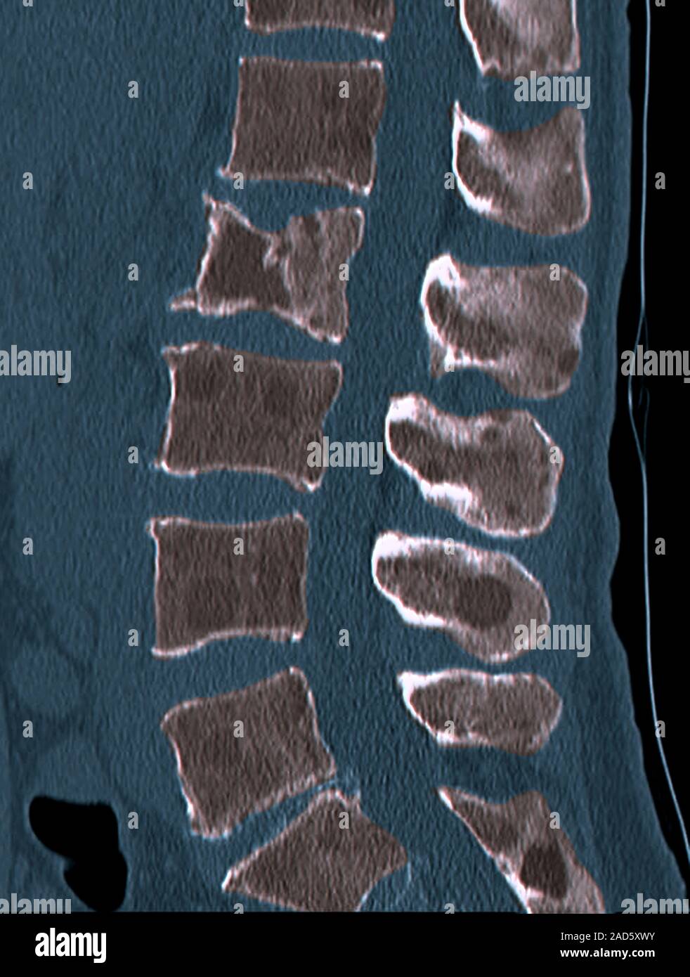 Secondary bone cancer in the spine. Coloured sagittal computed ...