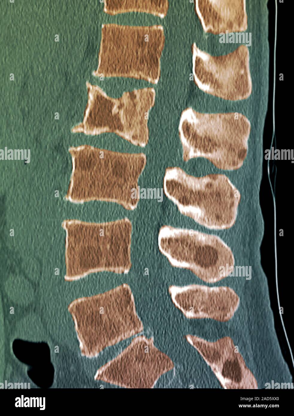 Secondary bone cancer in the spine. Coloured sagittal computed ...