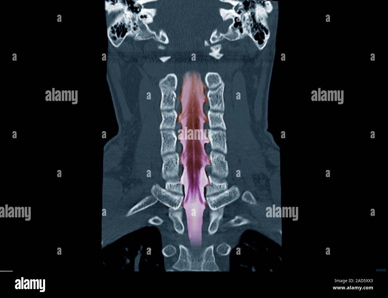 Neck bones and spinal cord. Coloured coronal computed tomography (CT ...