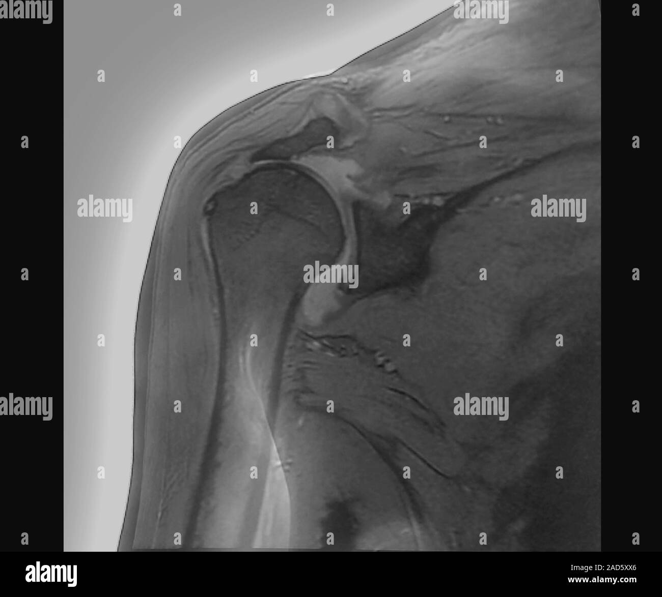 Shoulder tendon disorder. Coronal magnetic resonance imaging (MRI) scan ...