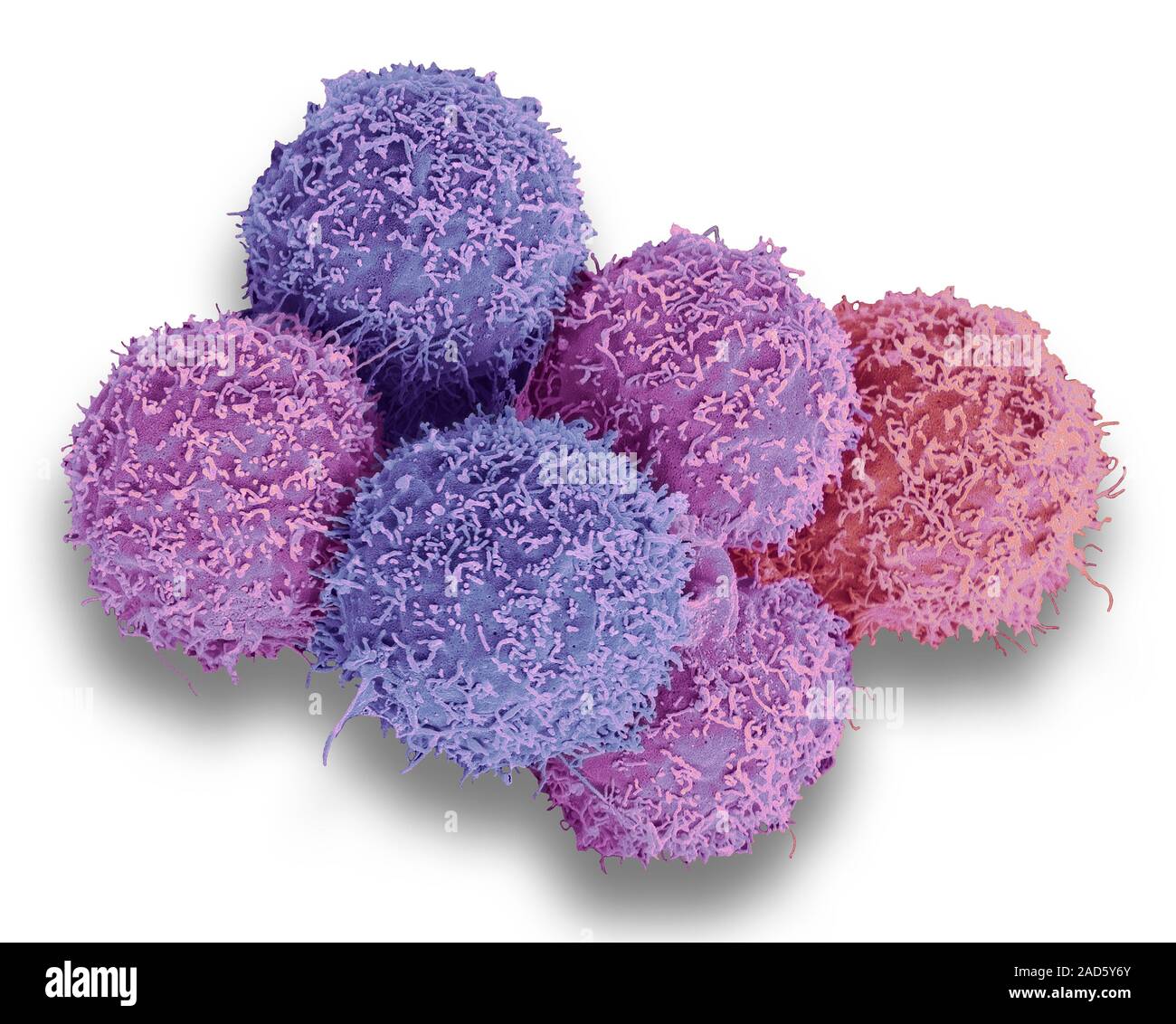 Bladder cancer cells. Coloured scanning electron micrograph (SEM) of ...
