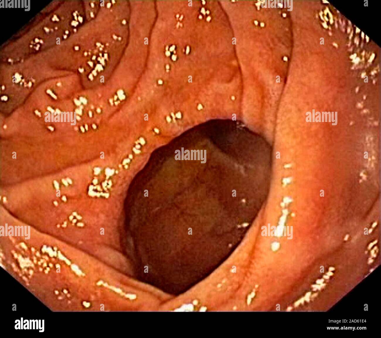 Diverticulum of the duodenum. Endoscope view of a diverticulum in the ...