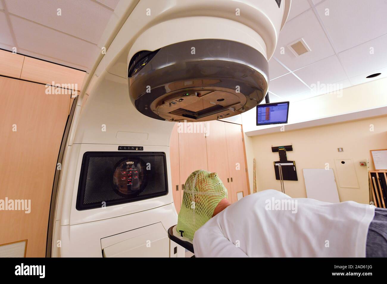 Brain cancer radiotherapy. 70-year-old woman with a malignant brain ...