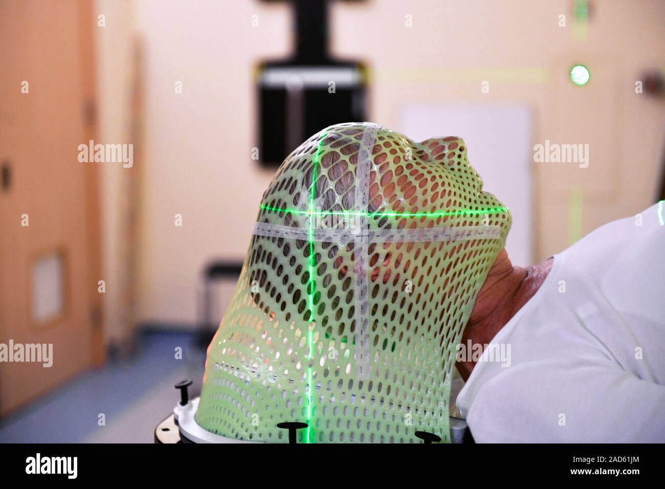 Brain cancer radiotherapy. 70-year-old woman with a malignant brain ...