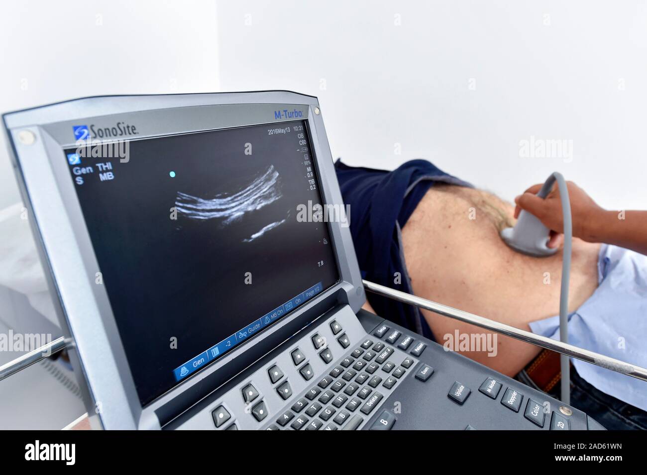 Ultrasound screening for abdominal aortic aneurysm. Ultrasound ...
