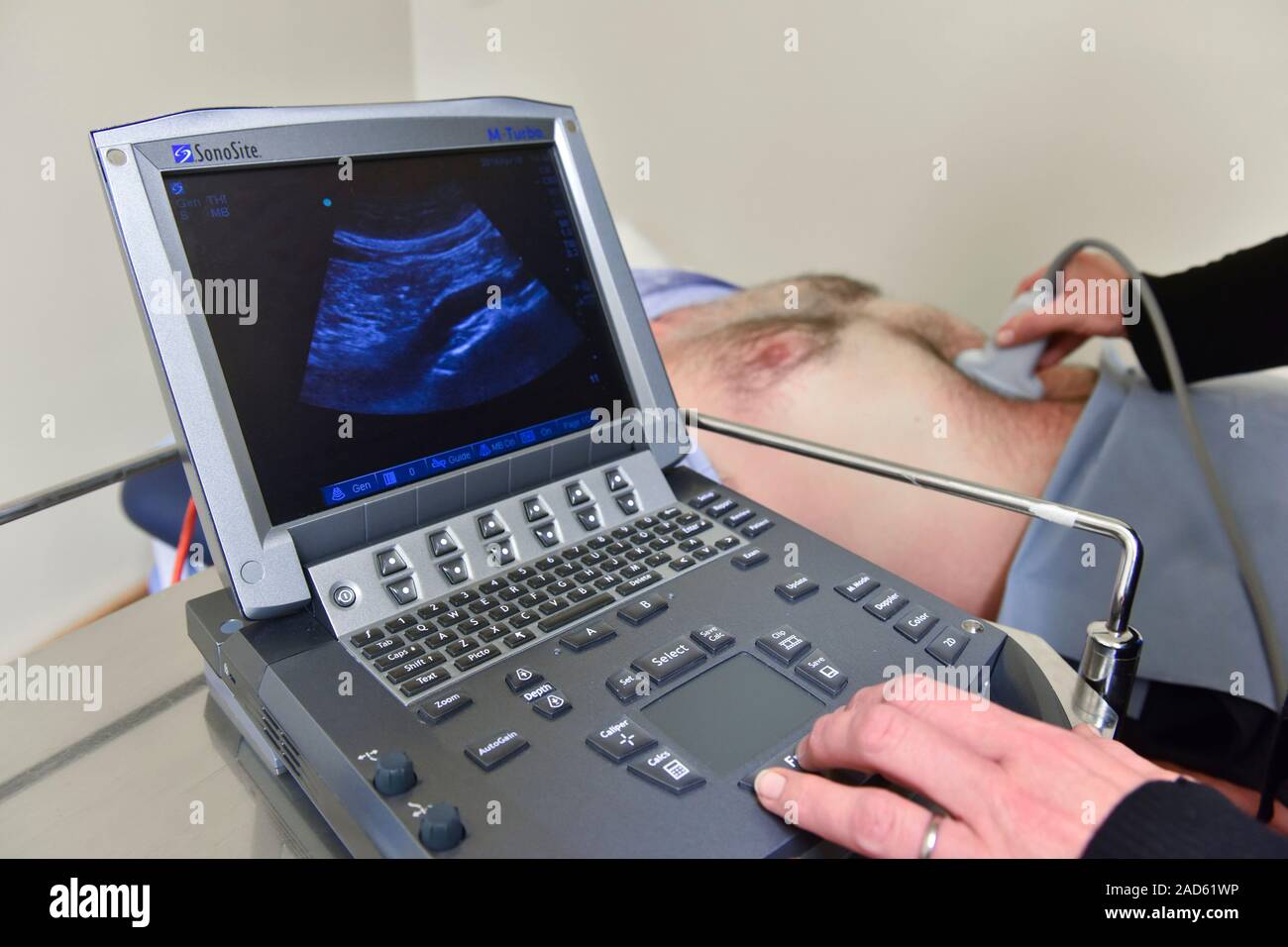 Ultrasound screening for abdominal aortic aneurysm. Ultrasound ...
