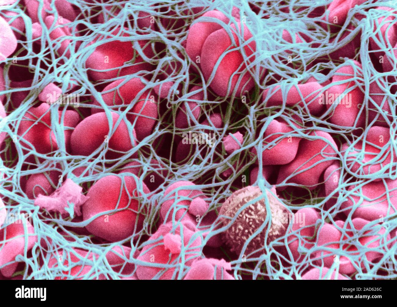 Blood clot, coloured scanning electron micrograph (SEM). Red blood ...