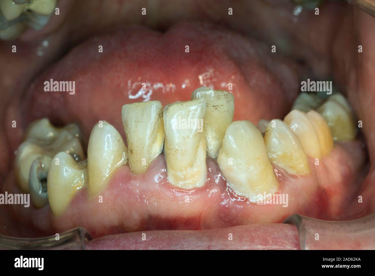 Crowded teeth covered with plaque and tartar. Close-up of a dental ...