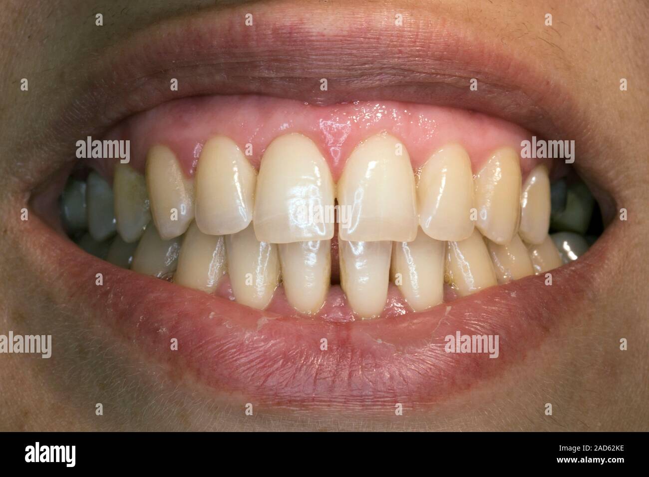 Healthy adult teeth. Frontal view of the teeth of the upper and lower ...
