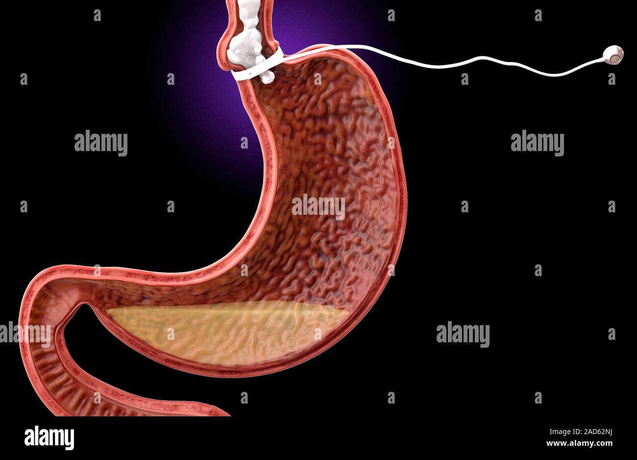 Illustration of gastric banding. A laparoscopic adjustable gastric band ...