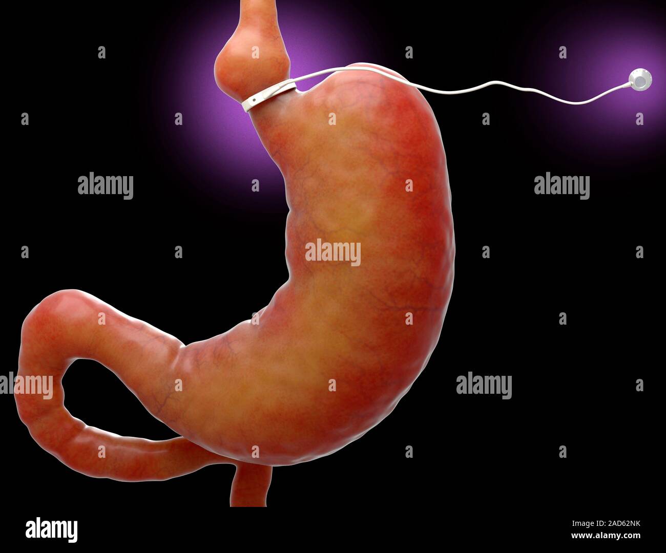 Illustration of gastric banding. A laparoscopic adjustable gastric band ...