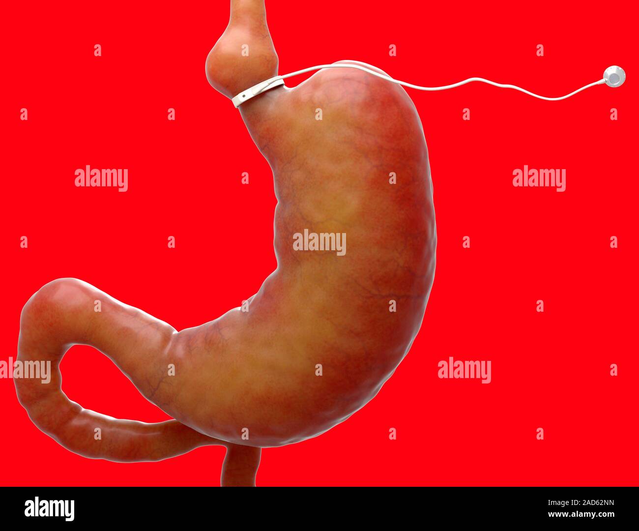 Illustration of gastric banding. A laparoscopic adjustable gastric band ...