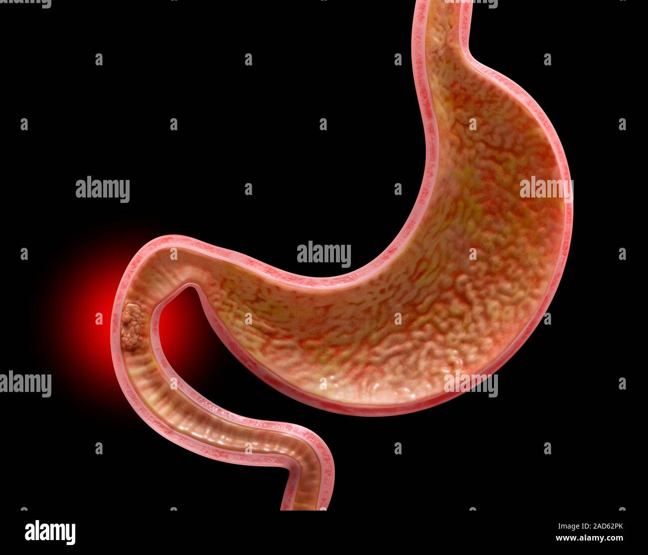 Cancer of the small intestine. Illustration of a tumour growing in the ...