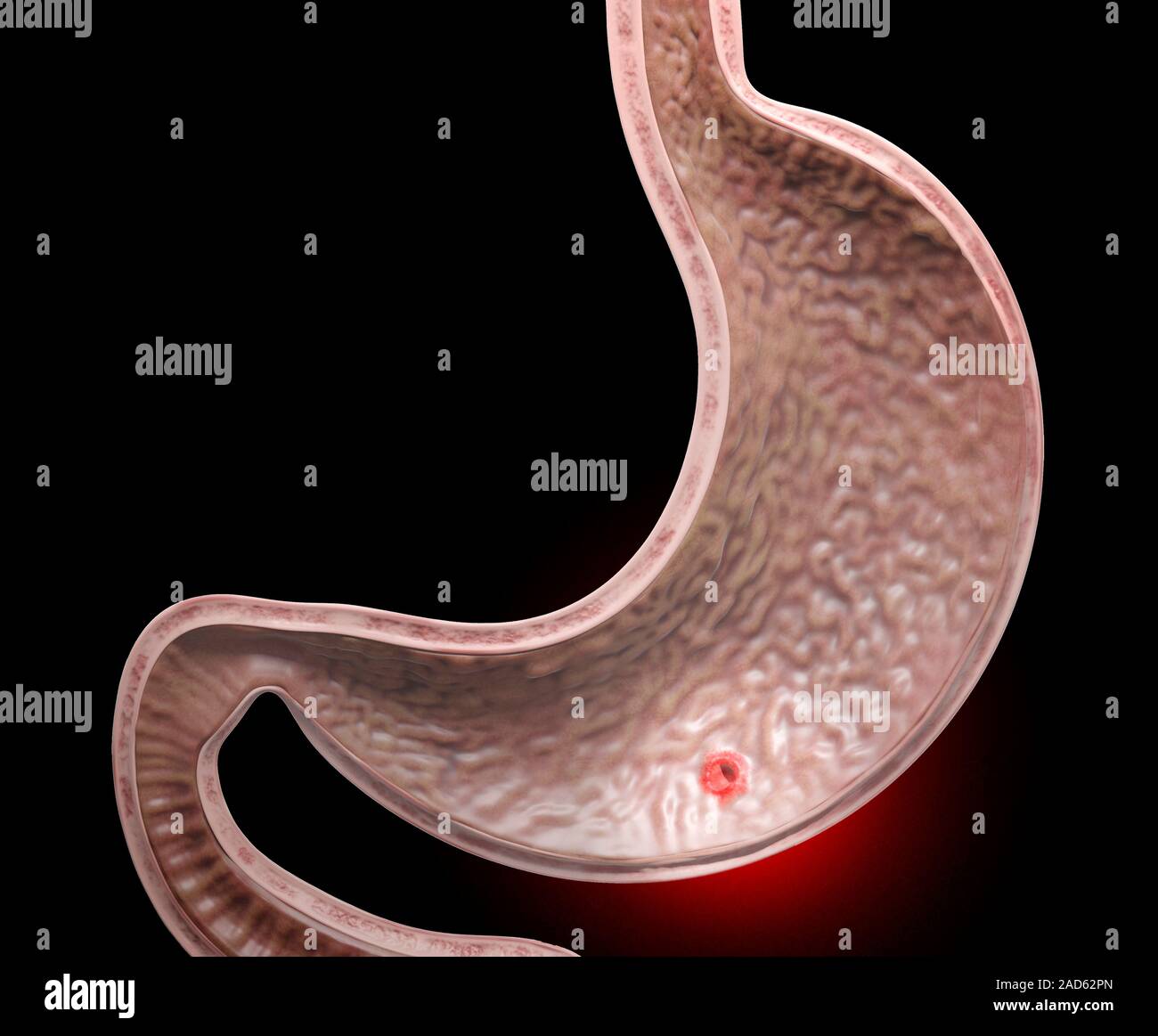 Gastric ulcer. Illustration of an ulcer (red) in the lining of a human ...
