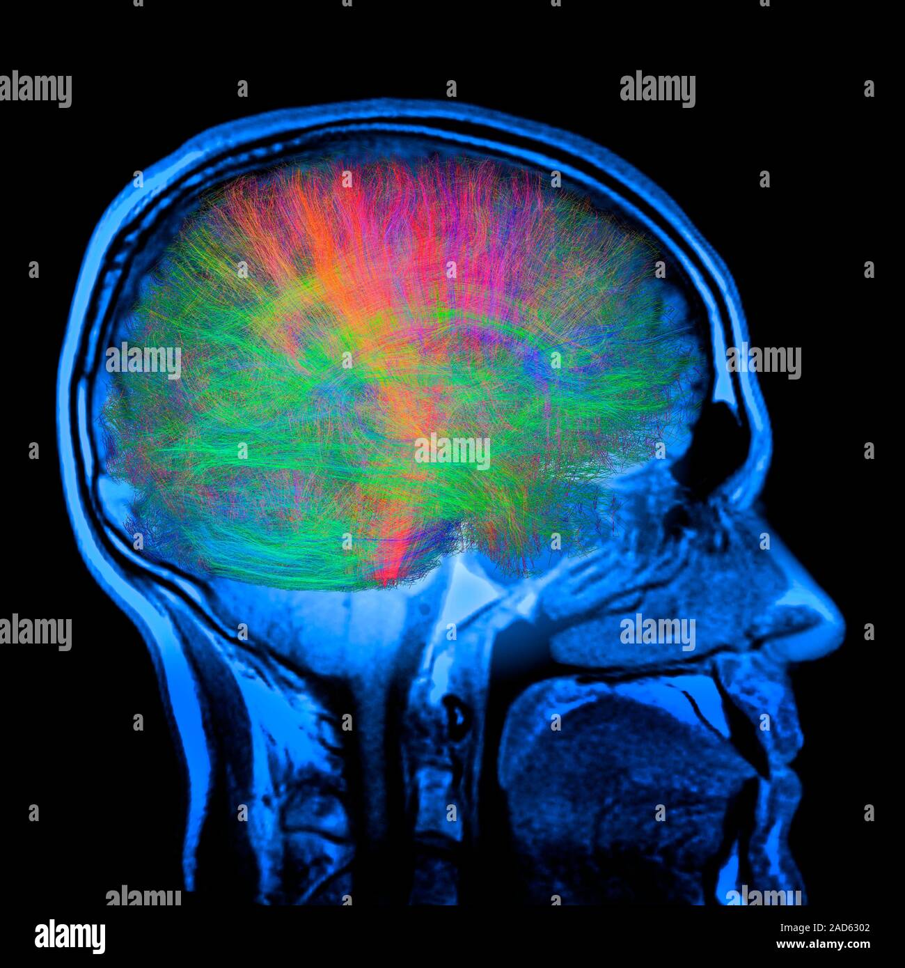 Computer artwork of a MRI side view of the brain showing white matter fibres. Coloured 3D ...