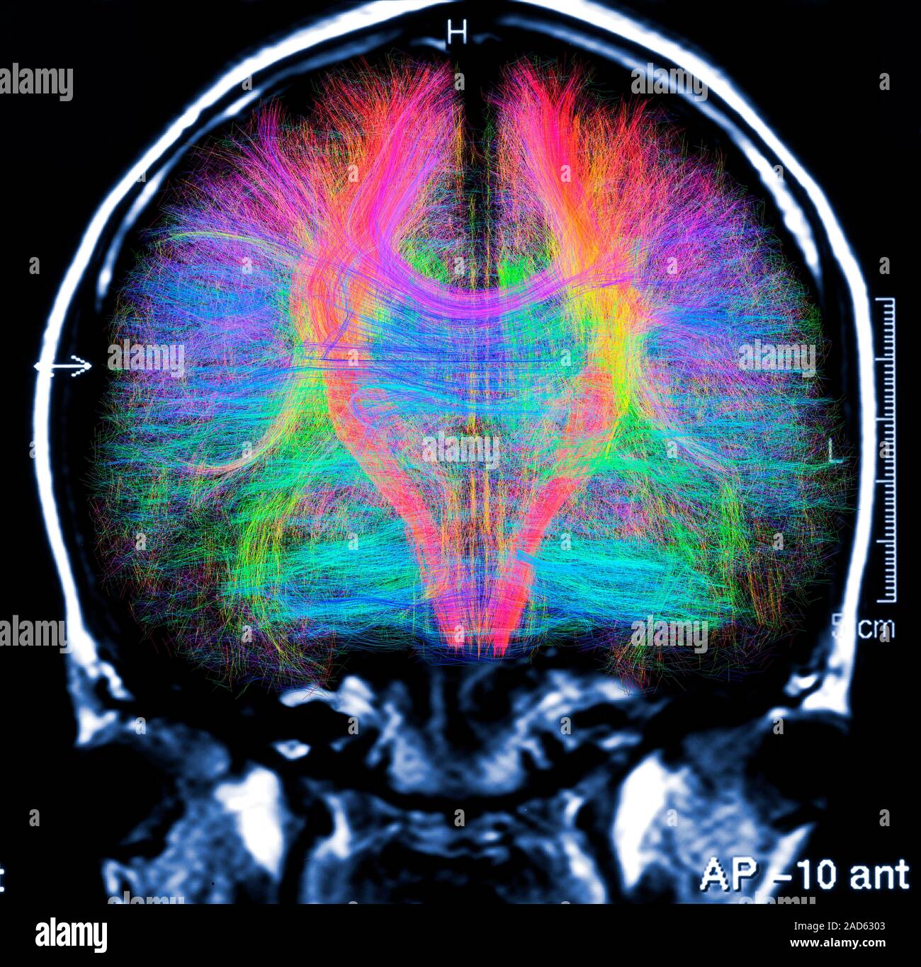 Computer artwork of a MRI frontal view of the brain showing white matter fibres. Coloured 3D ...