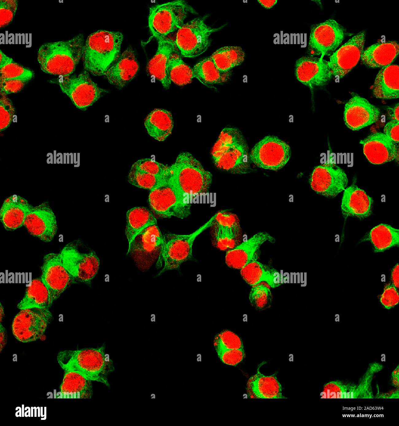 Neuroblastoma cells. Fluorescence light micrograph of cells from a type ...