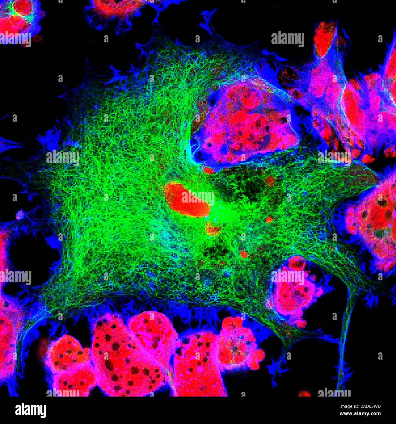 Neuroblastoma cells. Fluorescence light micrograph of cells from a type ...