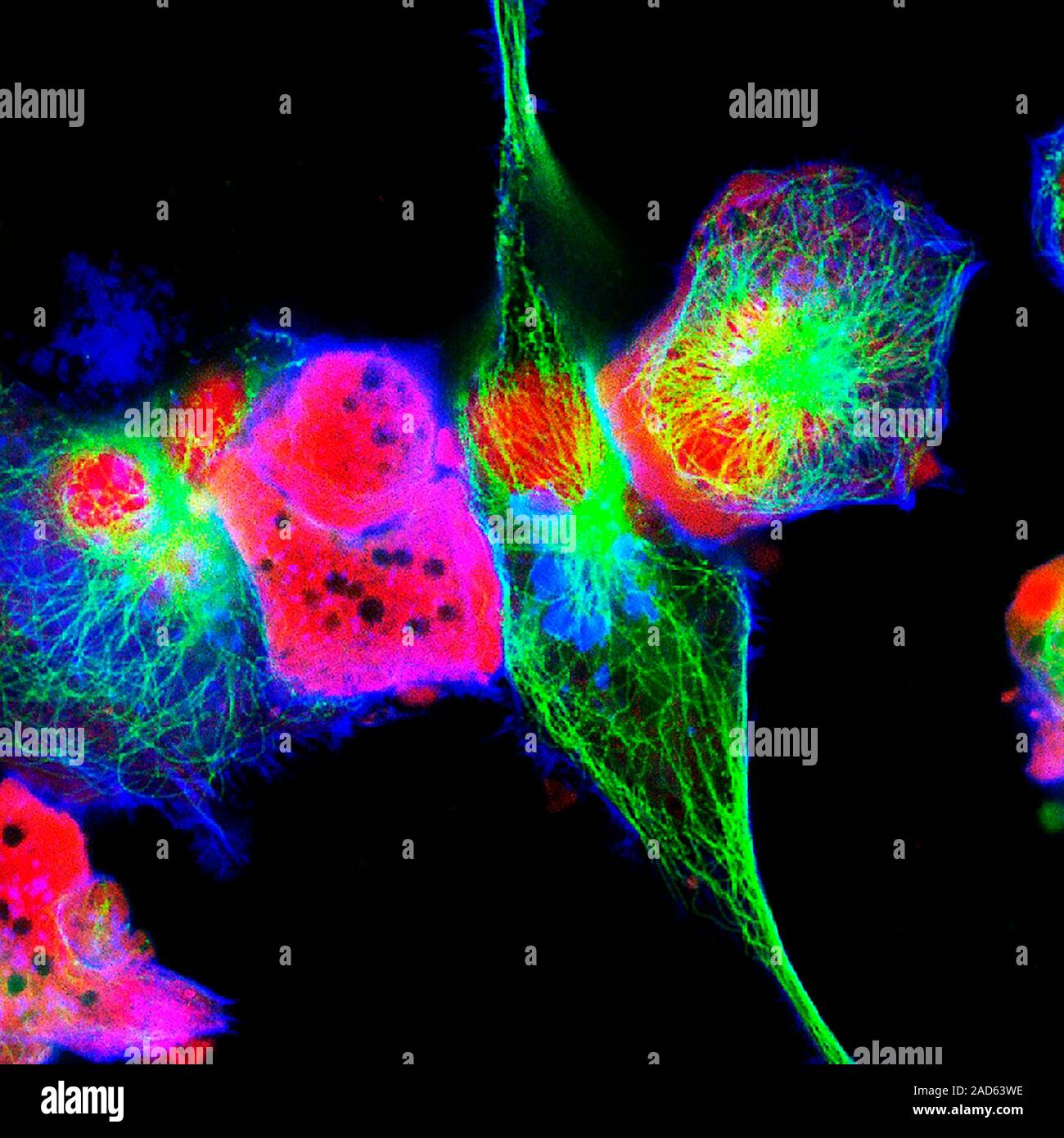 Neuroblastoma cells. Fluorescence light micrograph of cells from a type ...