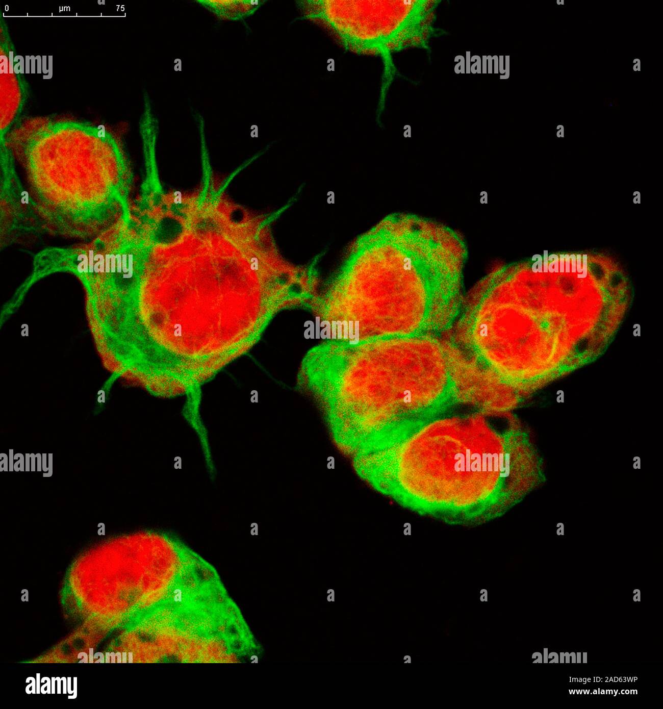 Neuroblastoma cells. Fluorescence light micrograph of cells from a type ...