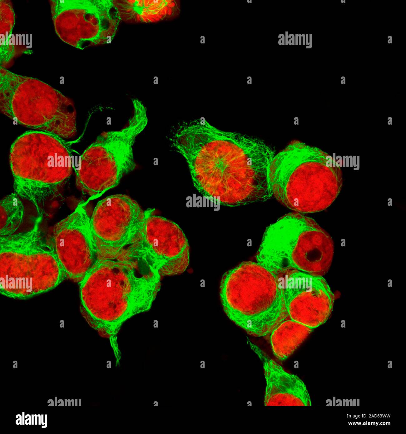 Neuroblastoma cells. Fluorescence light micrograph of cells from a type ...