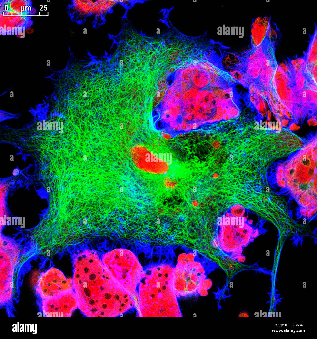 Neuroblastoma cells. Fluorescence light micrograph of cells from a type ...