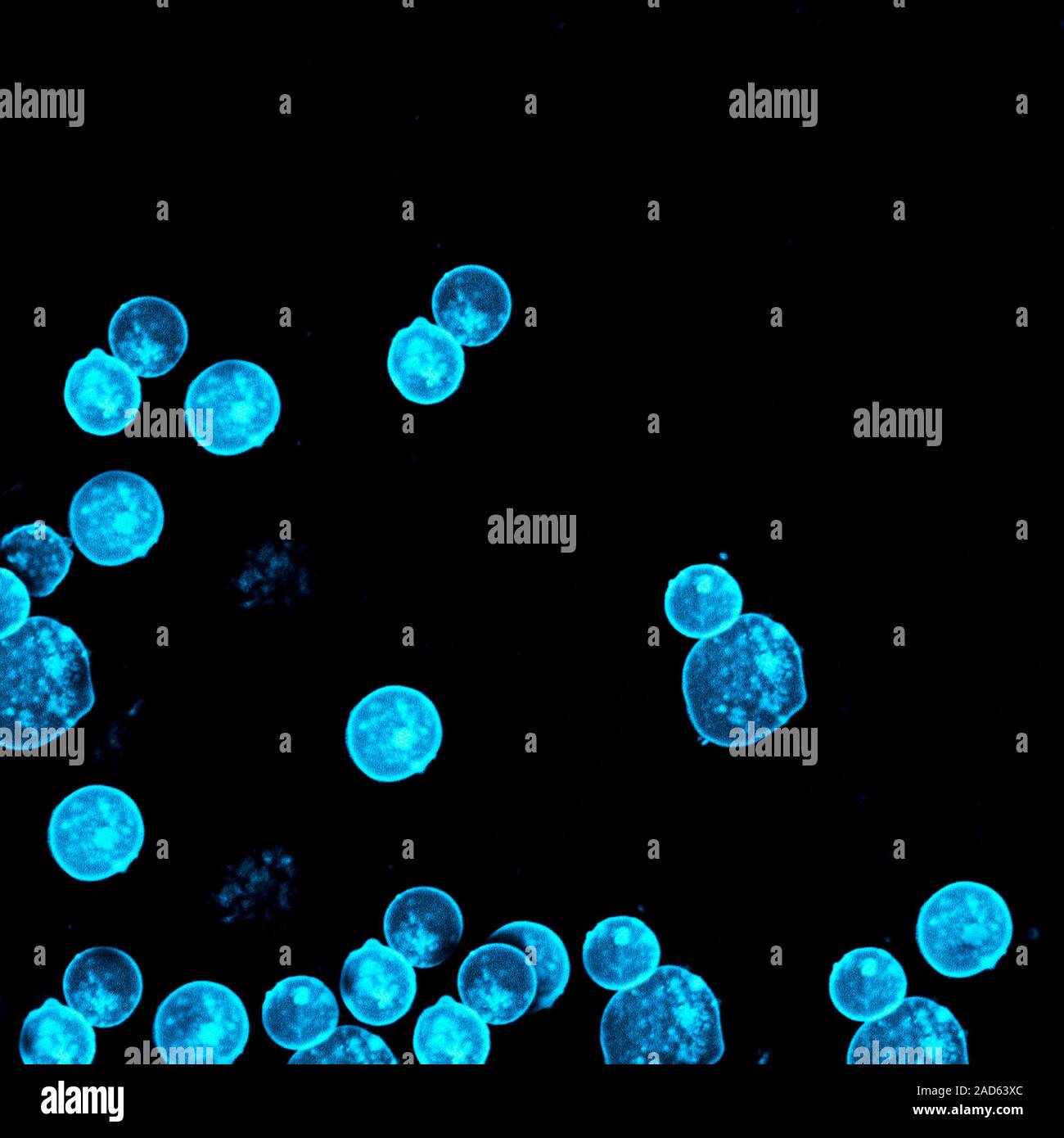 Leukaemia cancer cells. Fluorescence light micrograph of cells from a ...