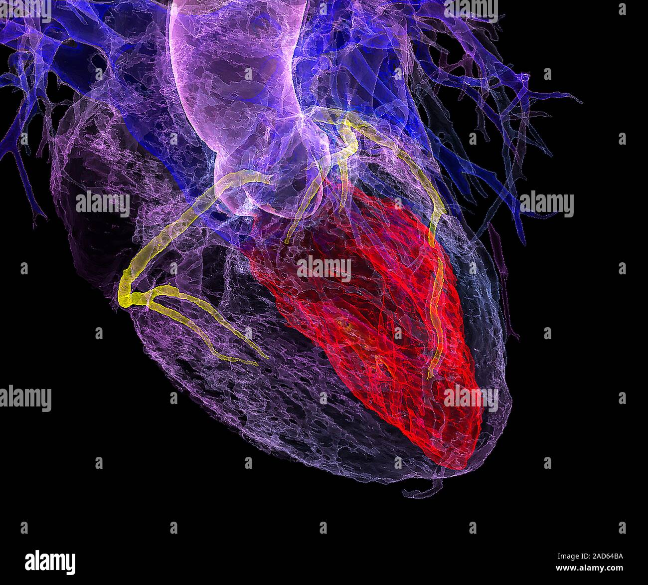 Heart in coronary artery disease. Illustration based on a 3D computed ...