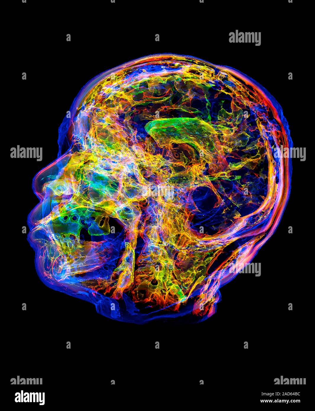 Human head and brain. Digitally enhanced 3D magnetic resonance imaging ...