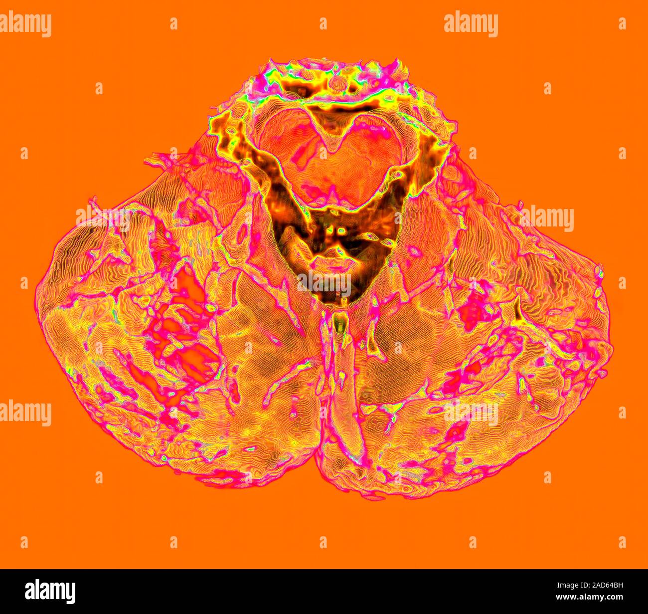 Human cerebellum. Digitally enhanced 3D magnetic resonance imaging (MRI ...