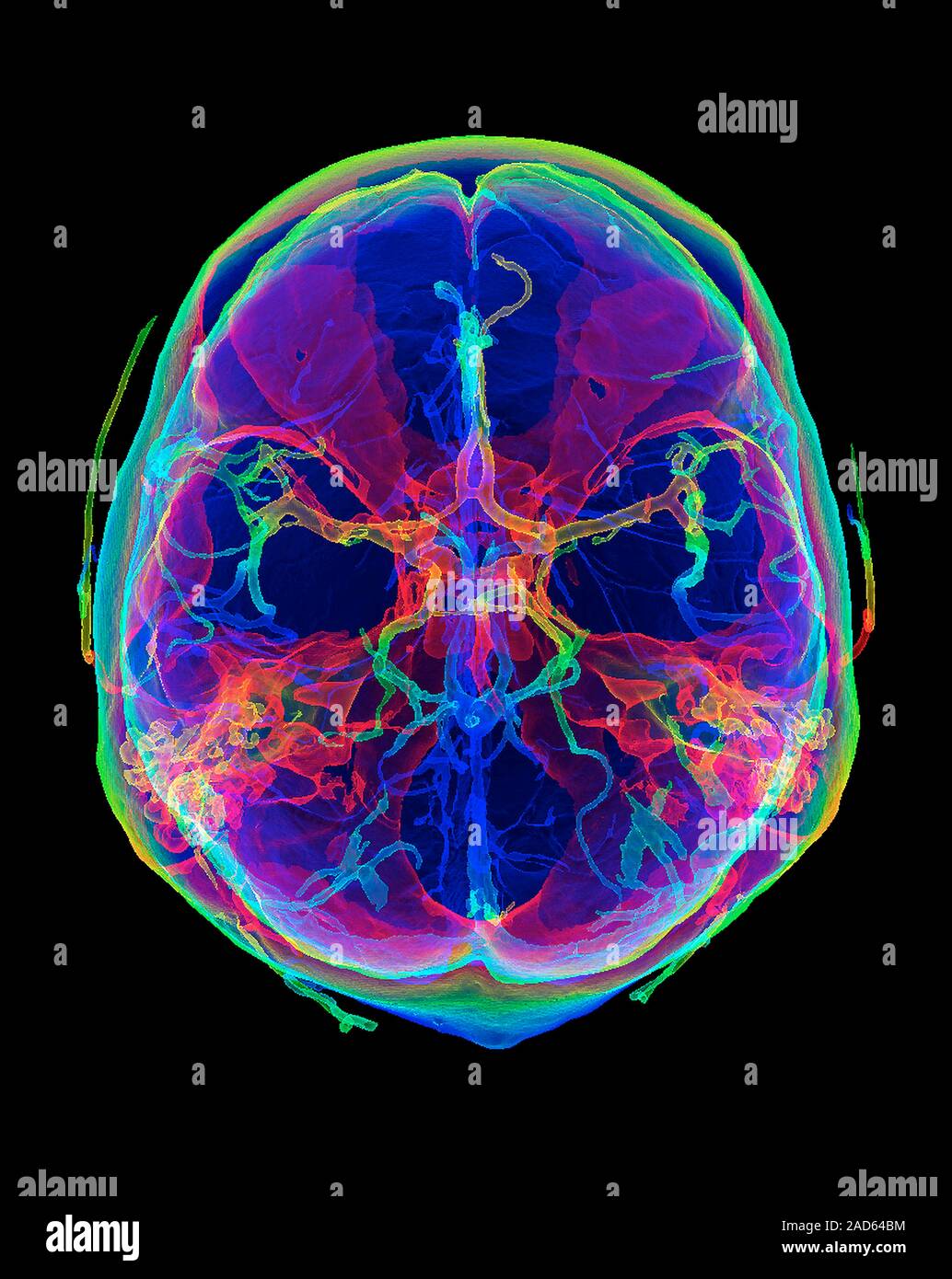 Intracranial blood vessels. Illustration based on a 3D computed ...