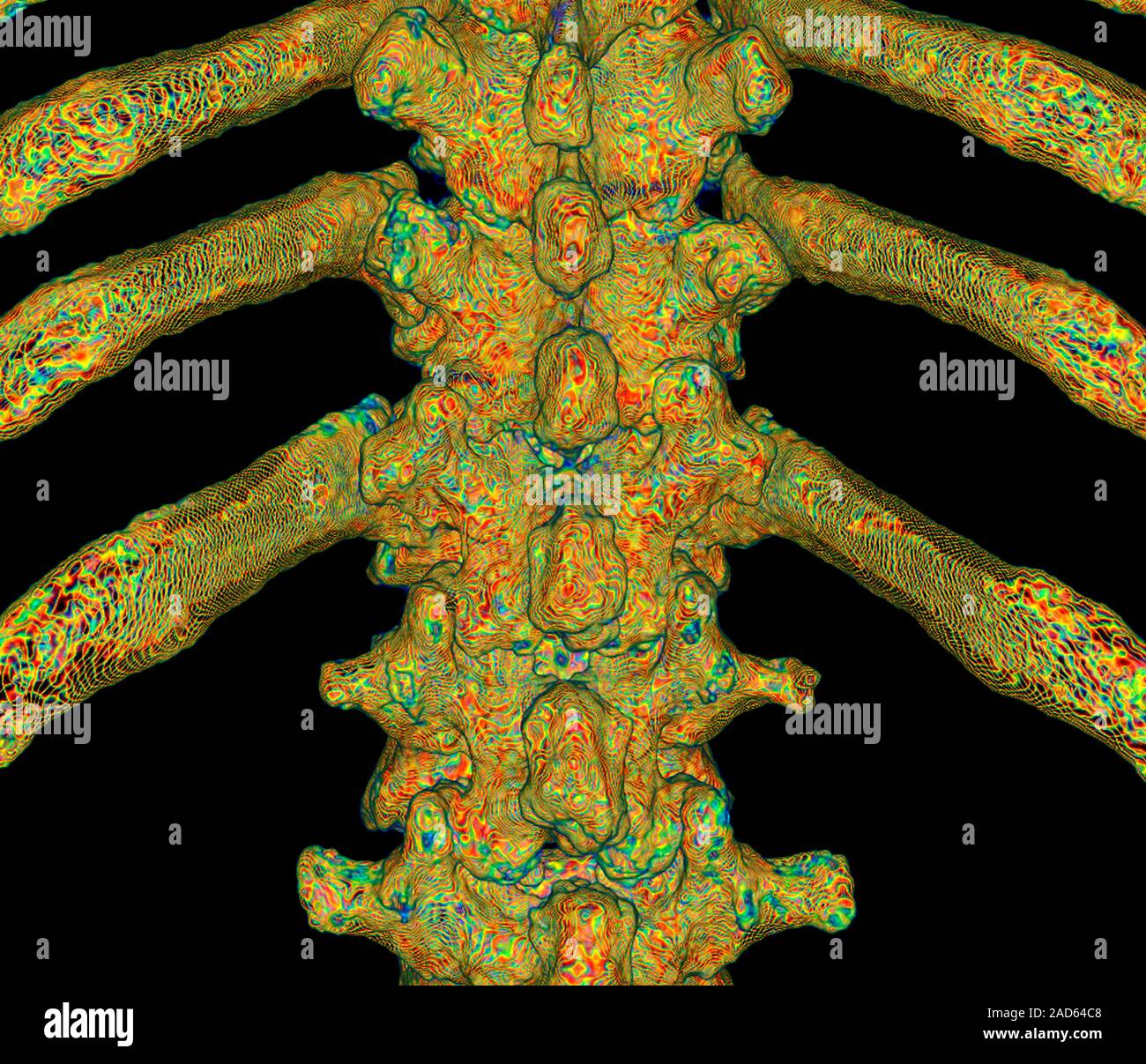 Thoracic spine anatomy. Digitally enhanced 3D computed tomography (CT ...