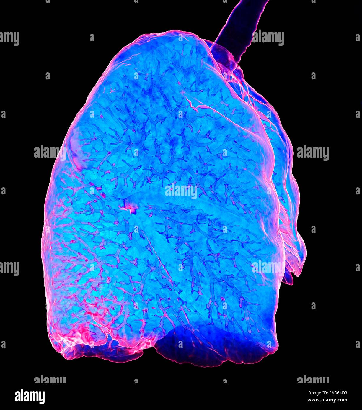 Scarred lungs. Digitally enhanced 3D computed tomography (CT) scan of ...