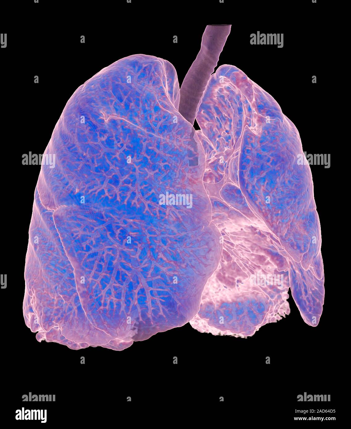 Scarred lungs. Digitally enhanced 3D computed tomography (CT) scan of ...