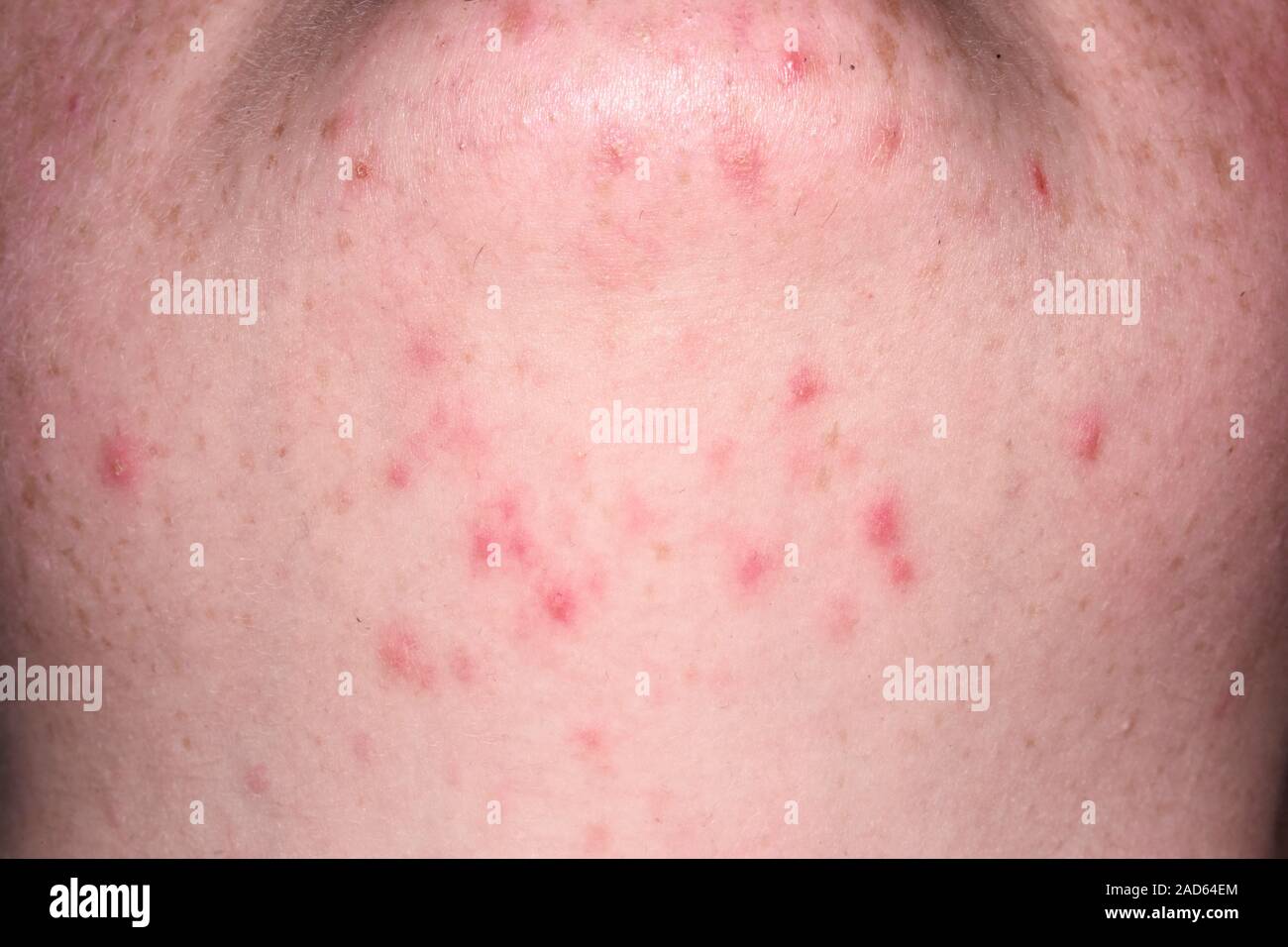 Folliculitis after waxing. Close-up of the chin of a 27-year-old female ...