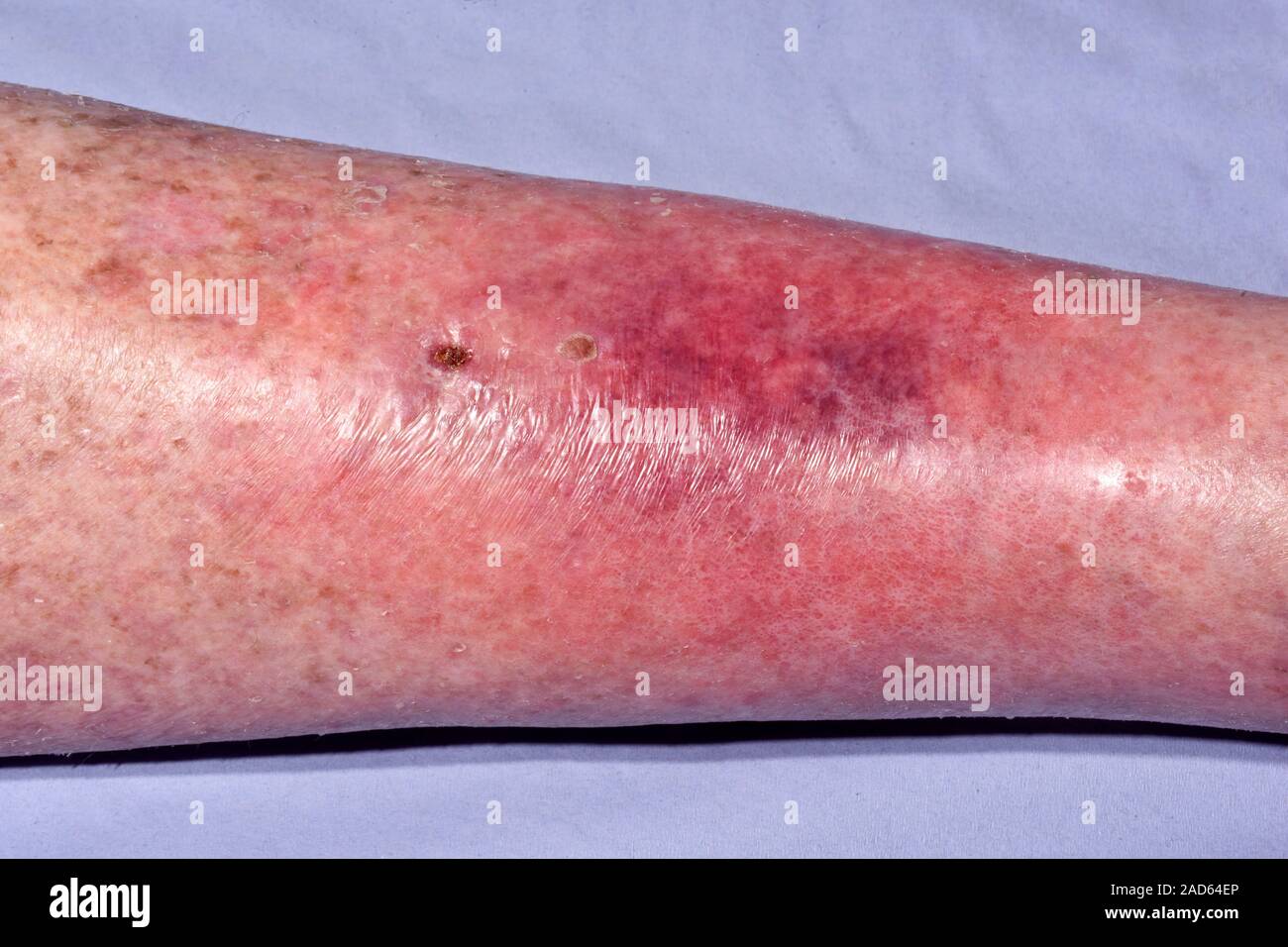 Cellulitis of the leg. Close-up of the swollen leg of a 72-year-old ...