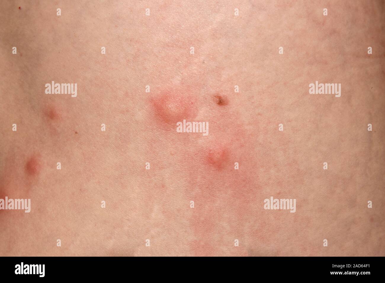 Allergic reaction to insect bites. Close-up of reddened and inflamed ...