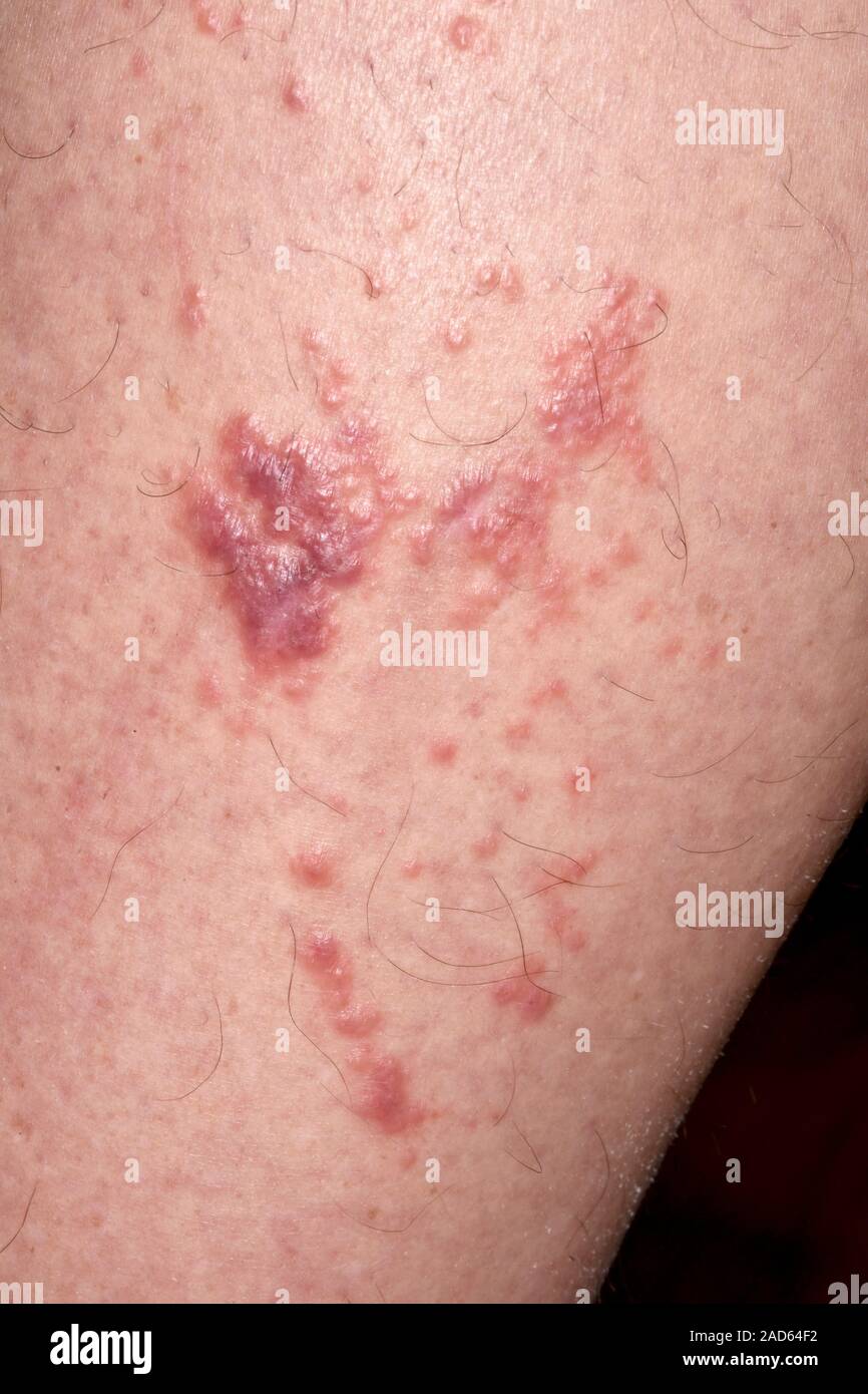Allergic reaction to coral injury. Close-up of a rash on the skin of a ...