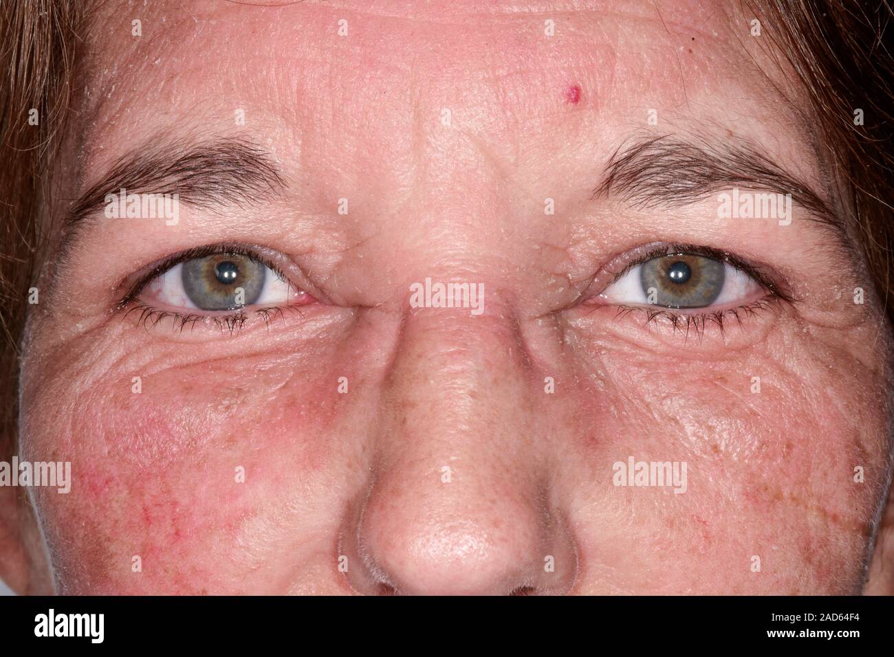 Angioedema. Close-up of the face and eyes of a 53-year-old female ...