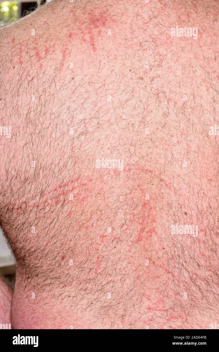 Dermatographic Urticaria On Back