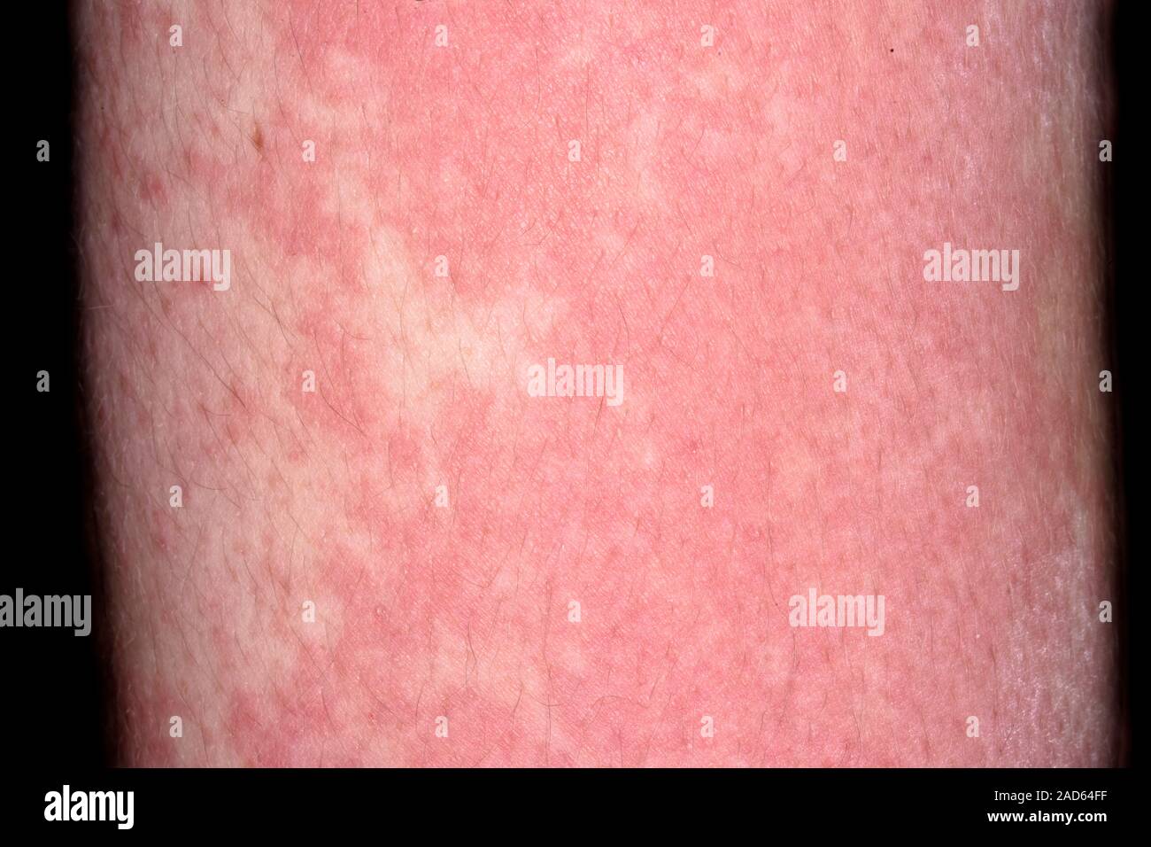 Urticaria in respiratory infection. Close-up of an urticaria (hives ...
