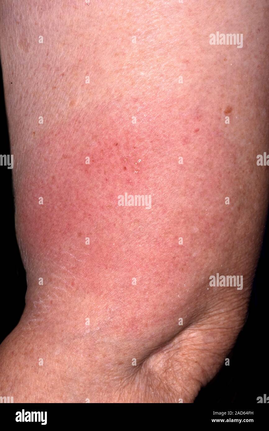 Allergic reaction to insect bite. Close-up of reddened and inflamed ...