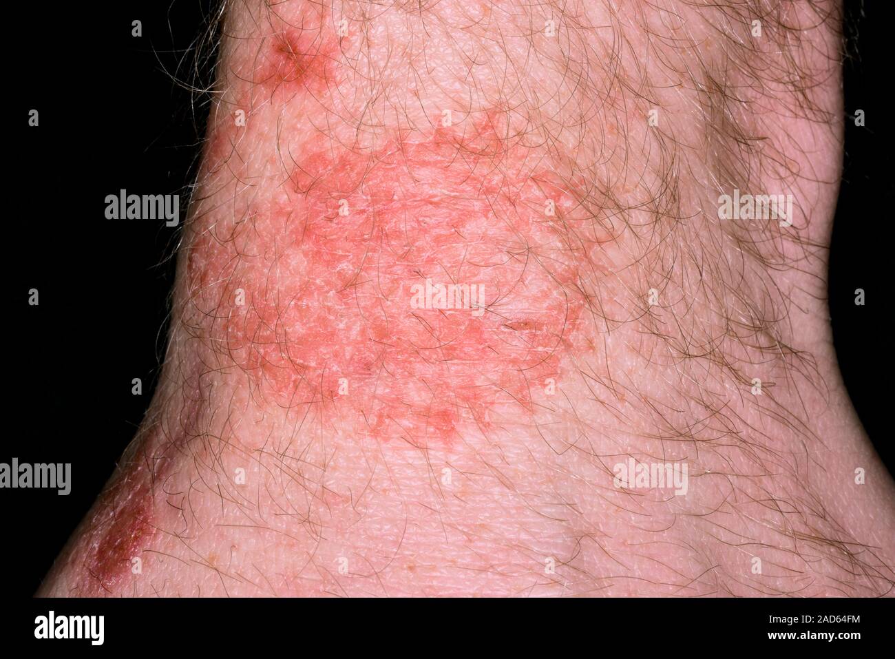 Contact dermatitis. Close-up of a rash on the wrist of a 22-year-old ...