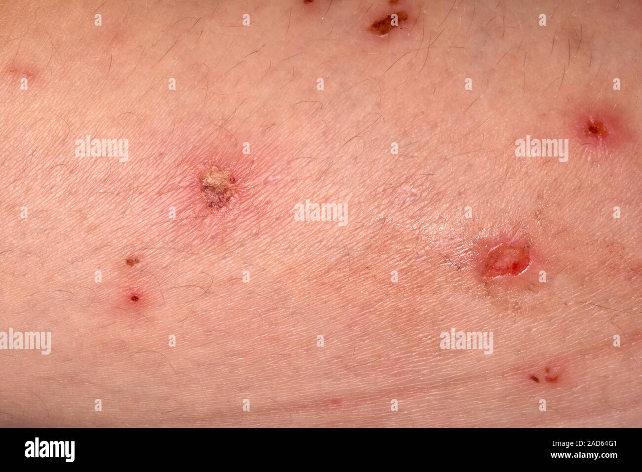 Infected eczema rash. Close-up of an infected rash on the skin of a 7 ...