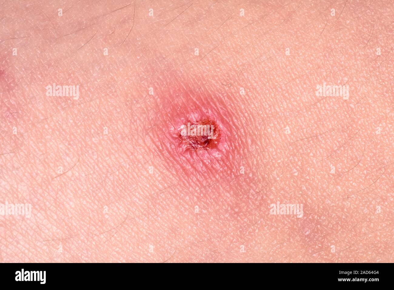 Infected eczema rash. Close-up of an infected rash on the skin of a 7 ...