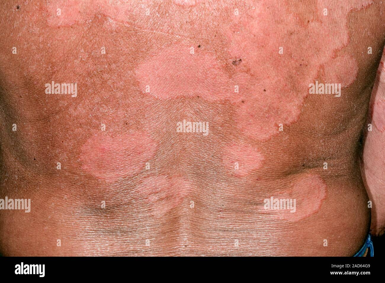 Ringworm Rash Close Up Of A Rash On The Back Of A 59 Year Old Male Patient Caused By Ringworm