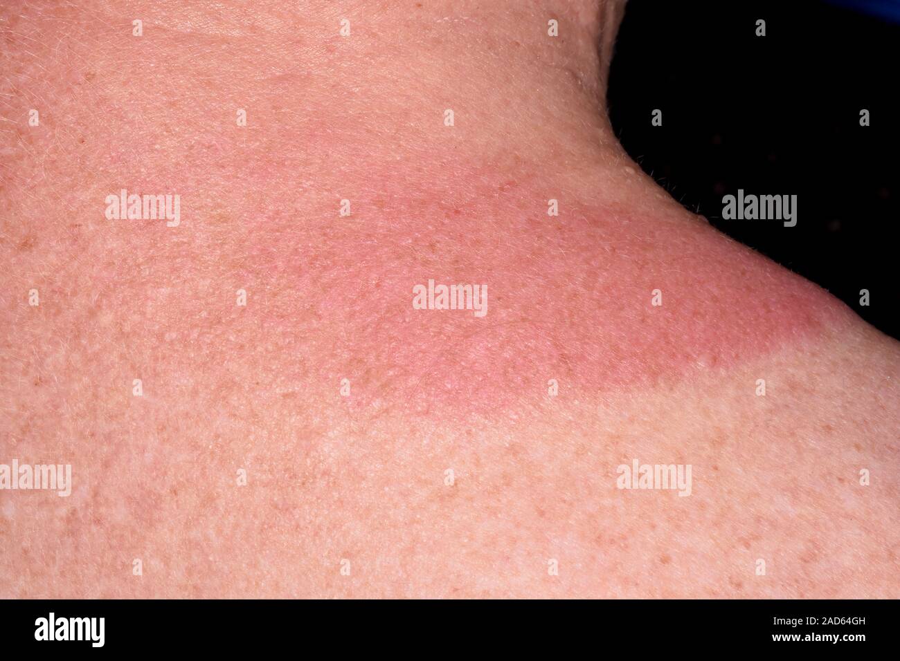 Sunburn. Close-up of sunburn on the neck of a 60-year-old female ...