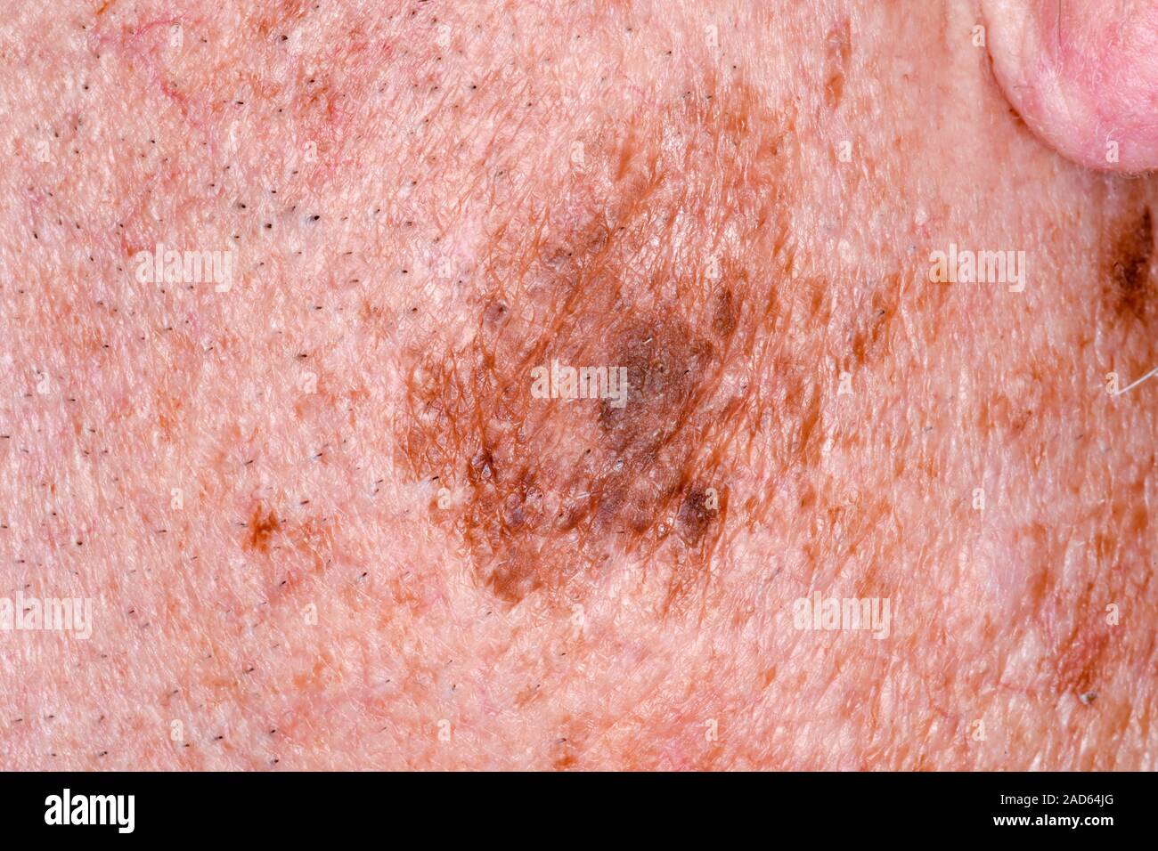 Hutchinsons lentigo skin cancer. Close-up of abnormal pigmentation at the site of a melanoma ...