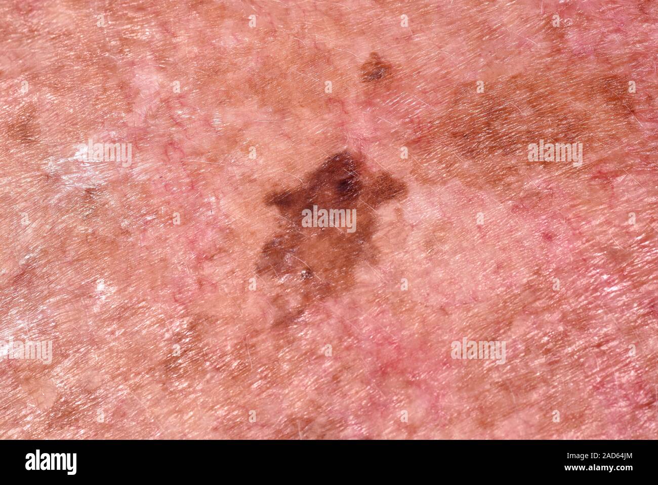 Hutchinsons lentigo skin cancer. Close-up of abnormal pigmentation ...